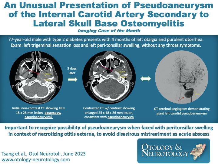 Peritonsillar Abscess Carotid Artery And