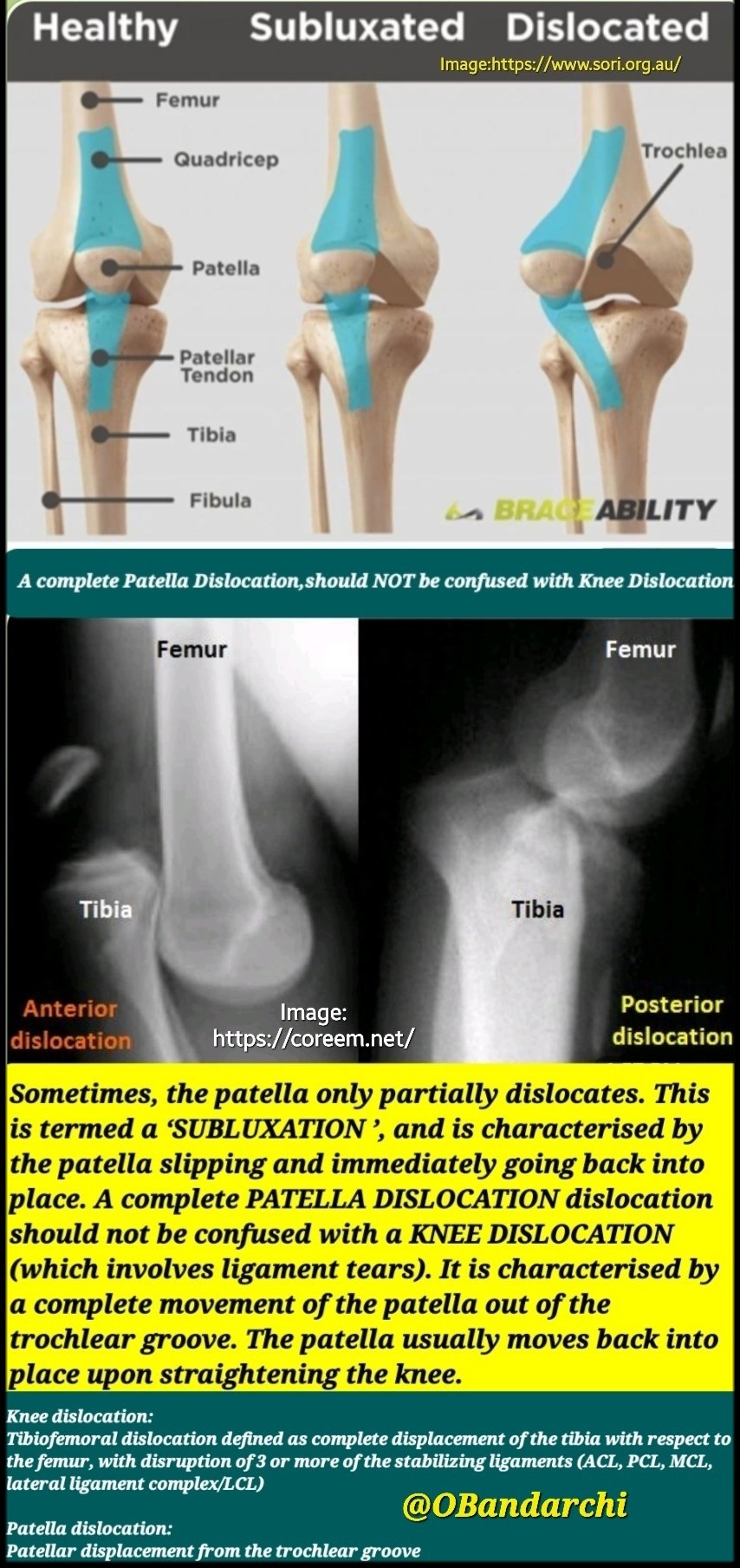 Anterior Knee Dislocation