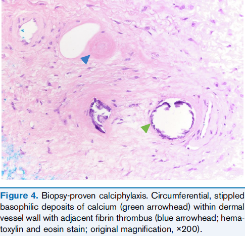 Calciphylaxis Histology