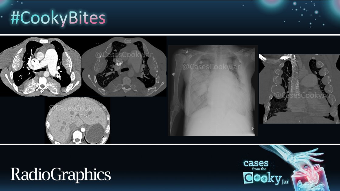 Cases From the Cooky Jar on Twitter: "39 year-old woman with transfusion-dependent thalassemia ...