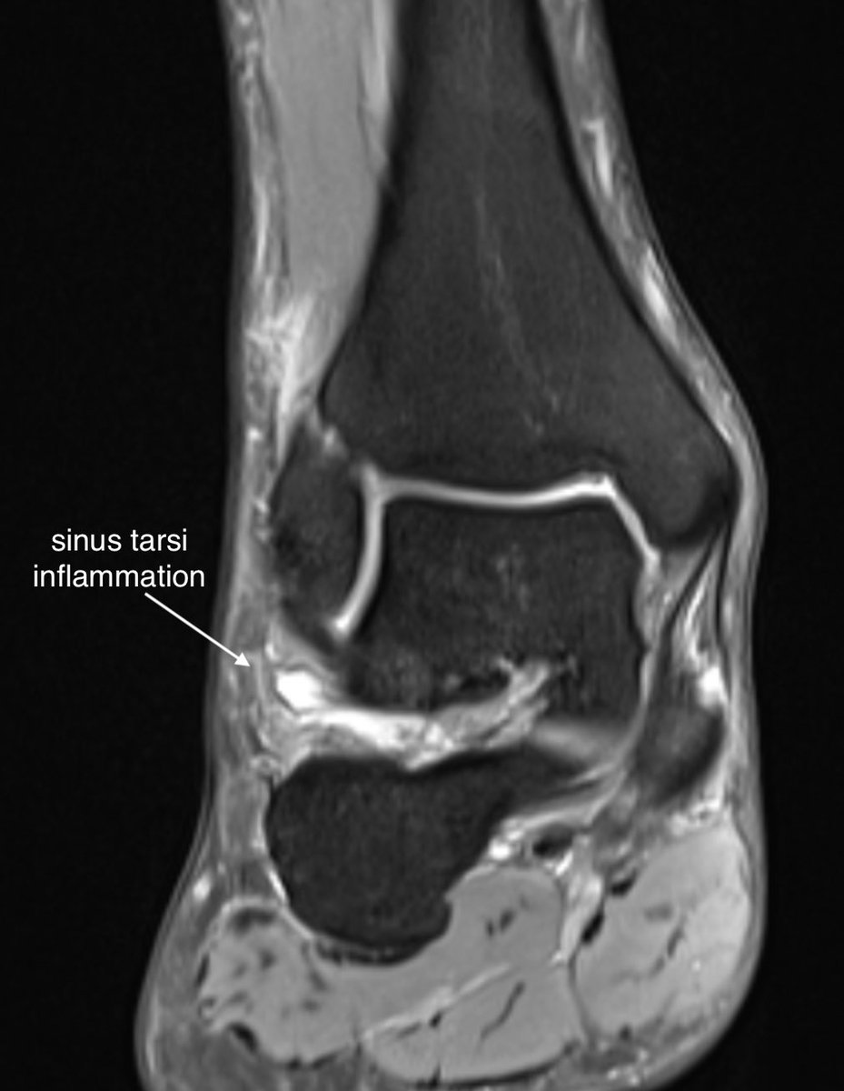 Sinus Tarsi Mri