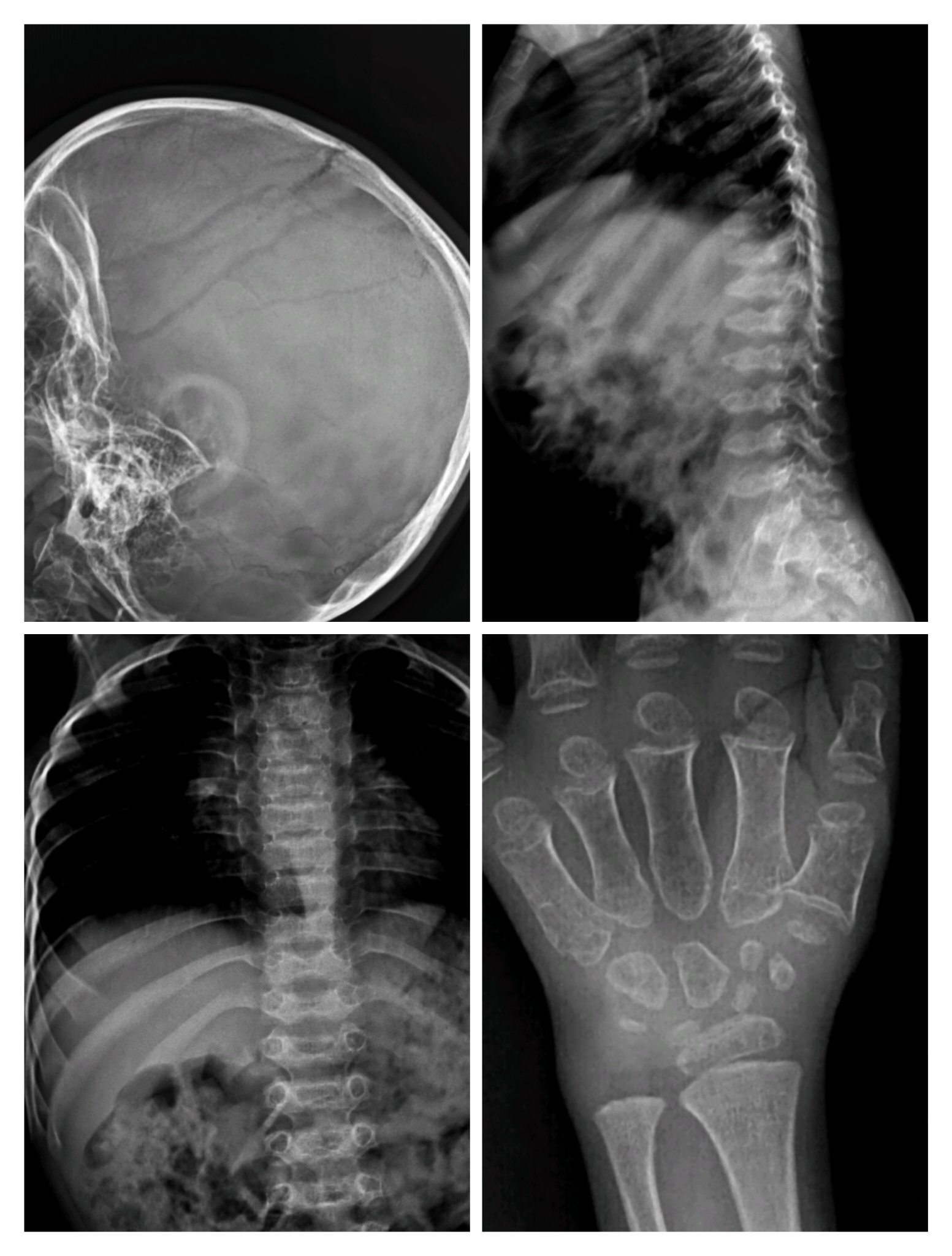 Rhizomelia Xray Skeletal Dysplasias: A Radiographic Approach And