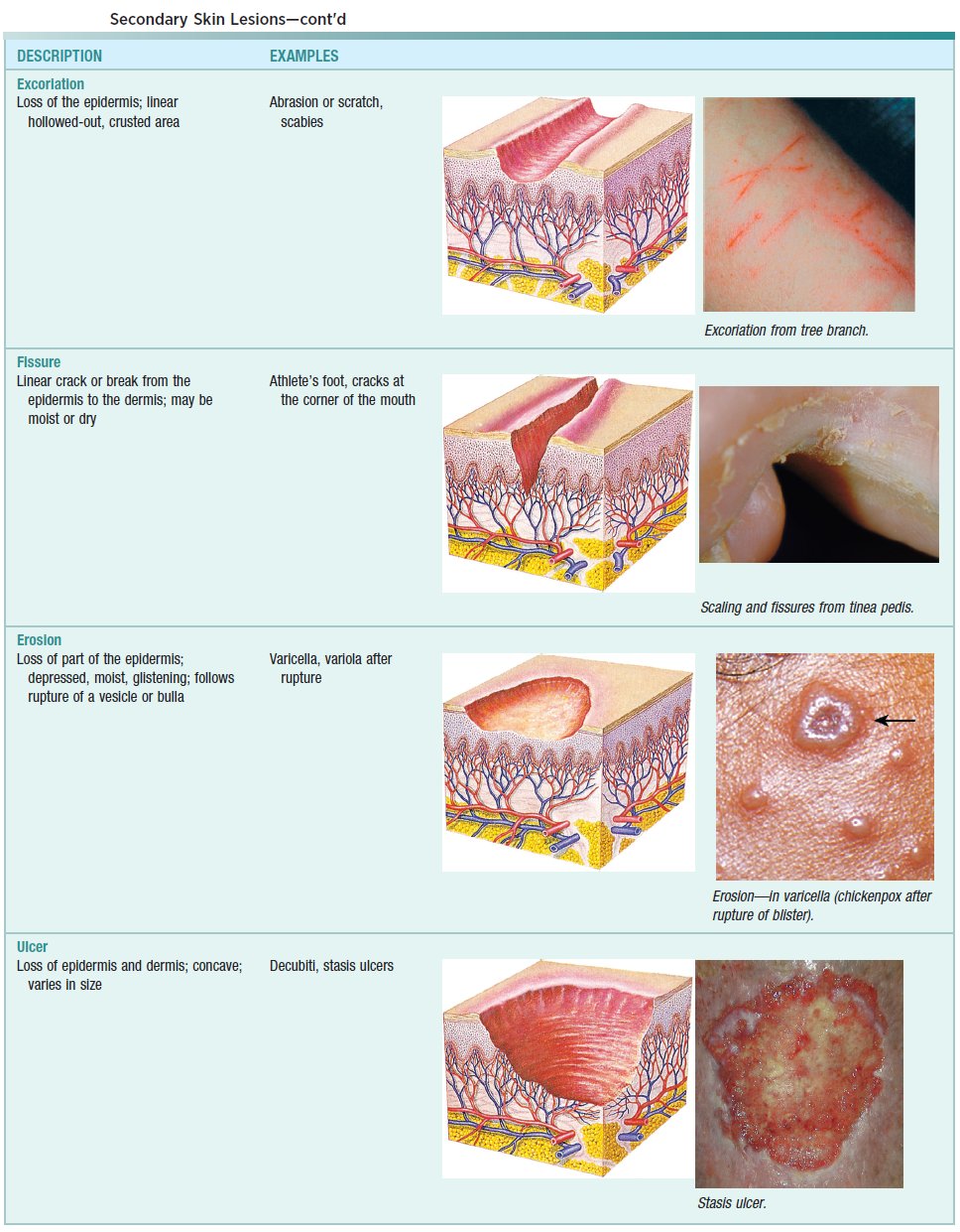 Excoriation Skin Lesion