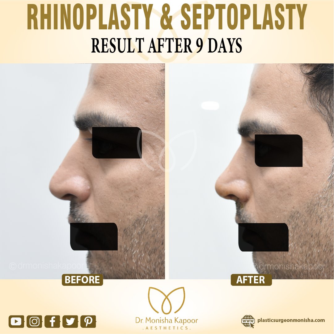 Septoplasty Only Before And After