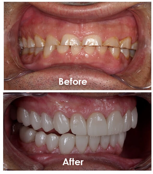 Are your teeth a mess? The dentist says you need $10,000+ of treatment ...
