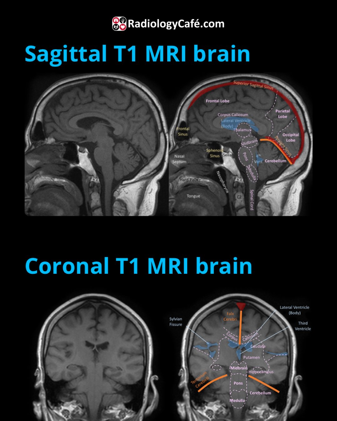 Sagittal Mri Brain Anatomy MRI Brain Sectional Anatomy Section 1