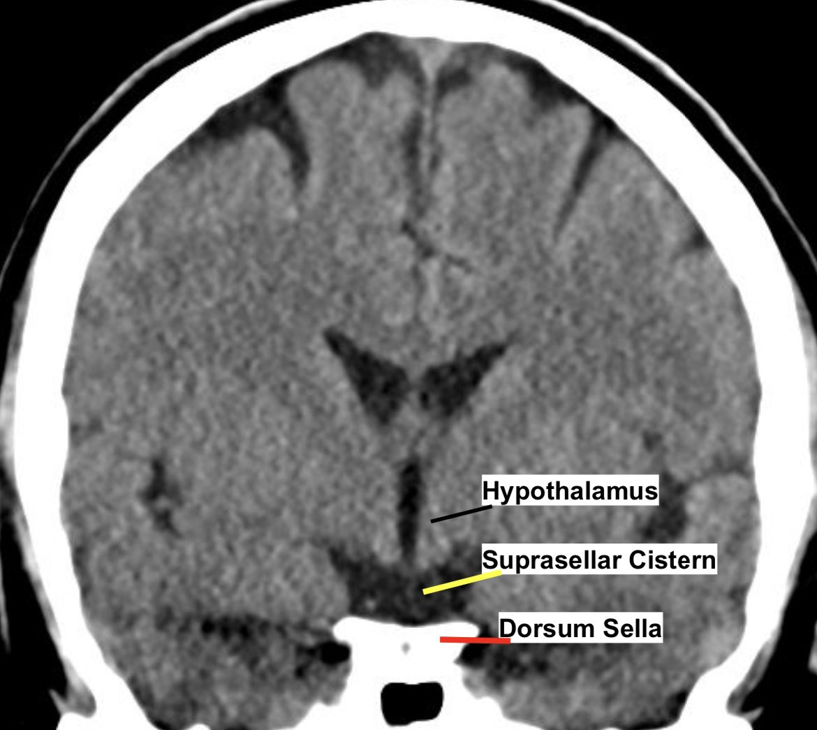 Suprasellar Cisterns