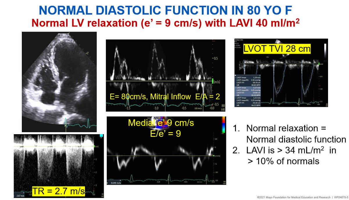 #0/7 Thanks @purviparwani for robust discussion on diastology which ...