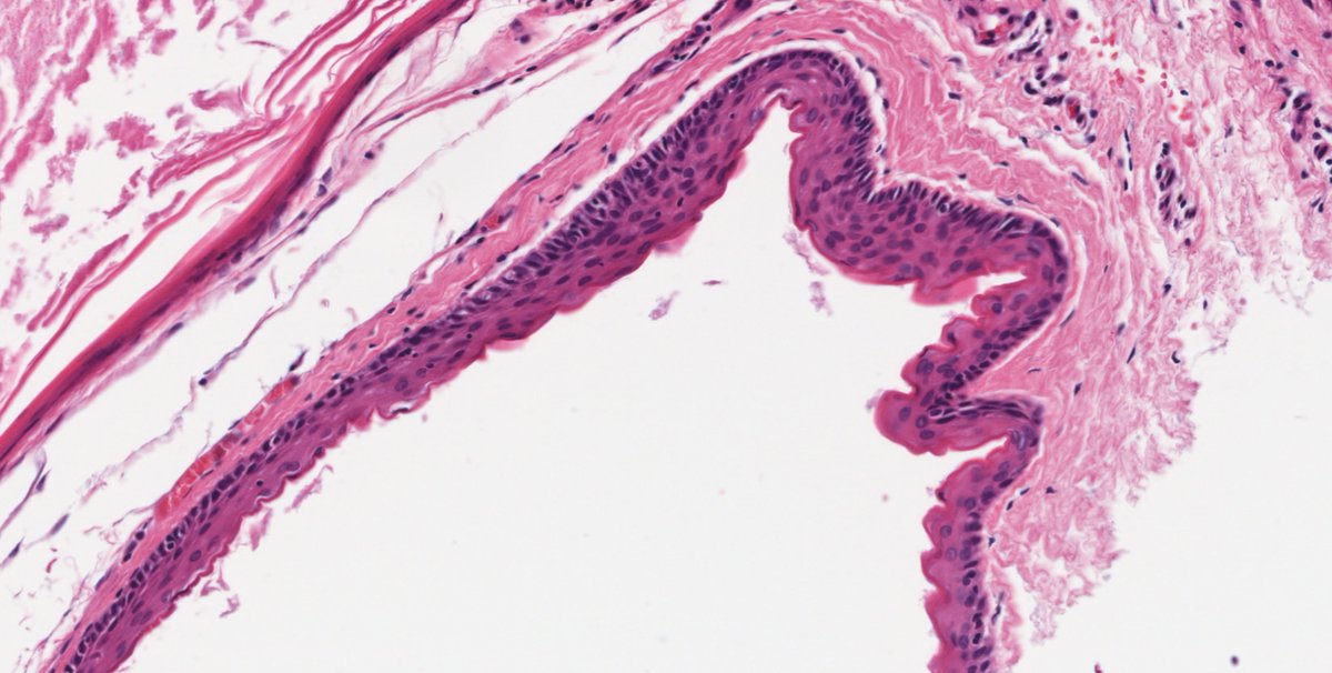 Steatocystoma -Thin stratified squamous epithelium -No granular layer ...