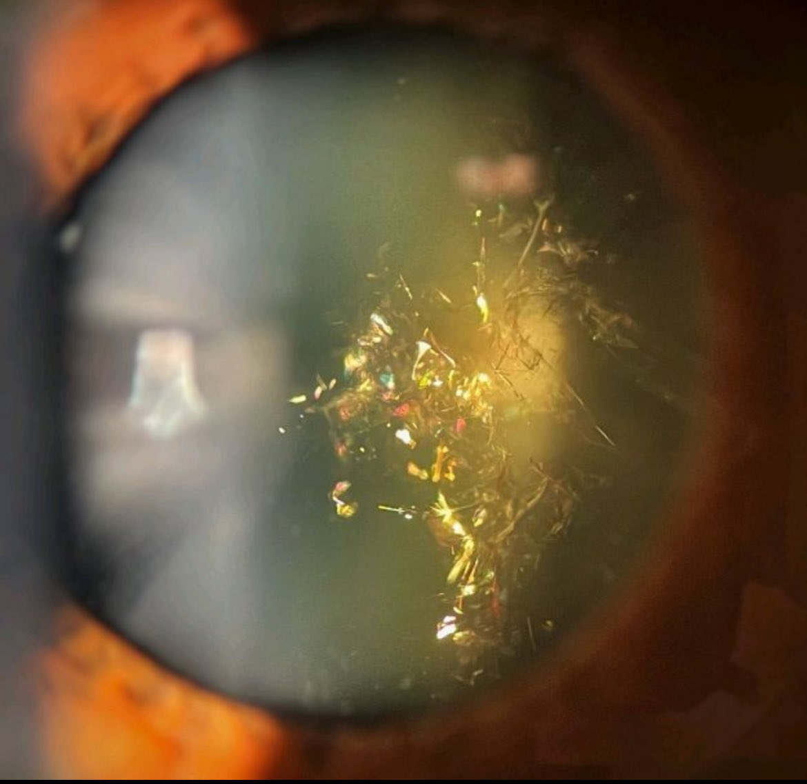 Christmas Tree Cataract Myotonic Dystrophy Congenital Cataract, Dr.