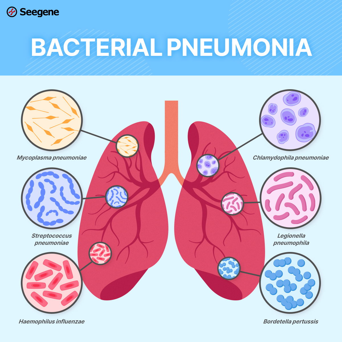 Pneumonia Bacteria Diagram X Ray Images Of COVID Positive Patient,