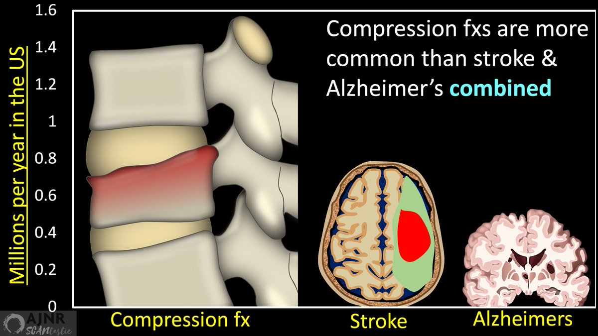 1/Reading spine studies with compression fractures is back-breaking ...