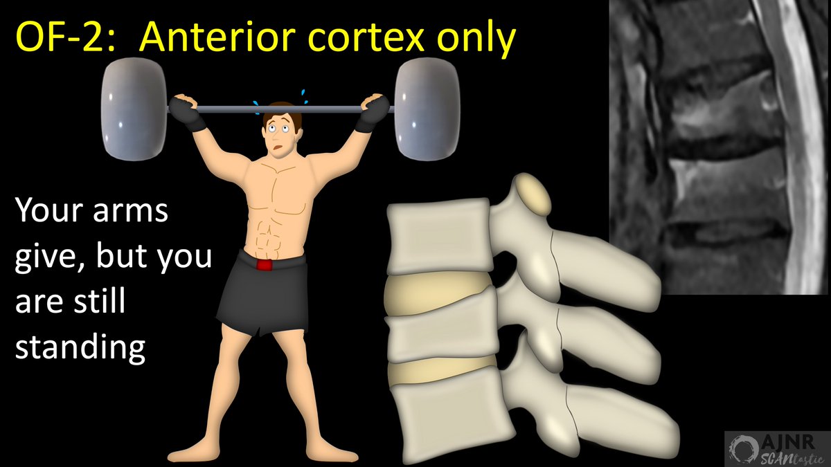 1/Reading spine studies with compression fractures is back-breaking ...