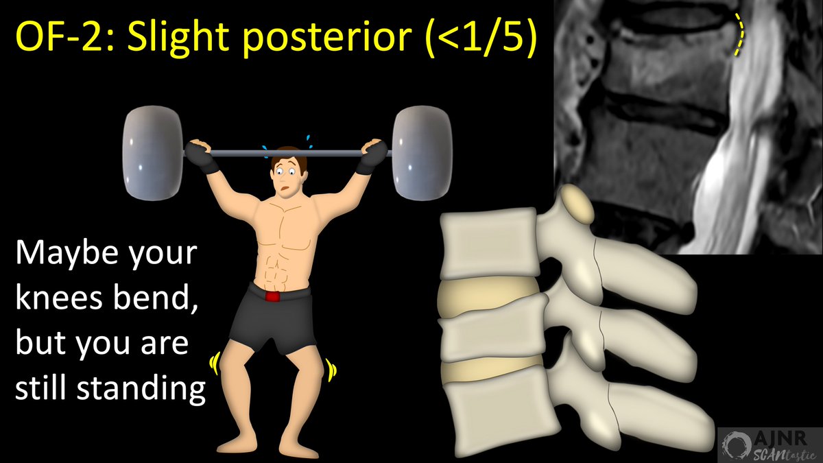 1/Reading spine studies with compression fractures is back-breaking ...