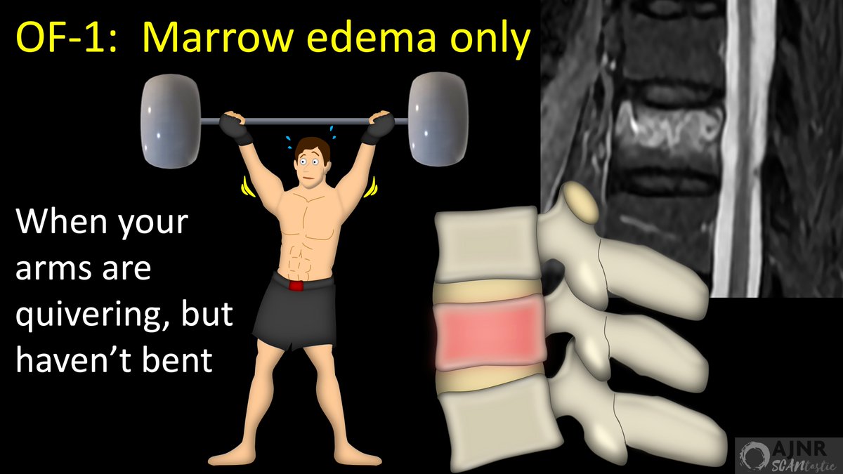 1/Reading spine studies with compression fractures is back-breaking ...