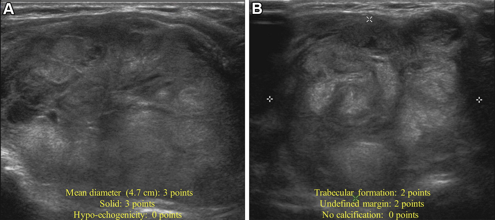 Subacute Thyroiditis Ultrasound Subacute Thyroiditis Wikipedia