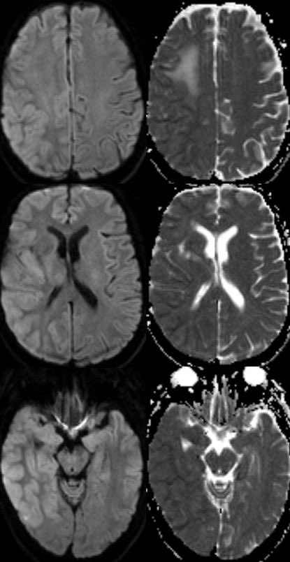 40 y/o M presents w/ seizures and severe headache. Patient has a hx of ...