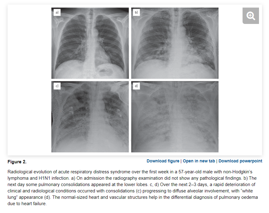 Respiratory Distress Syndrome X Ray