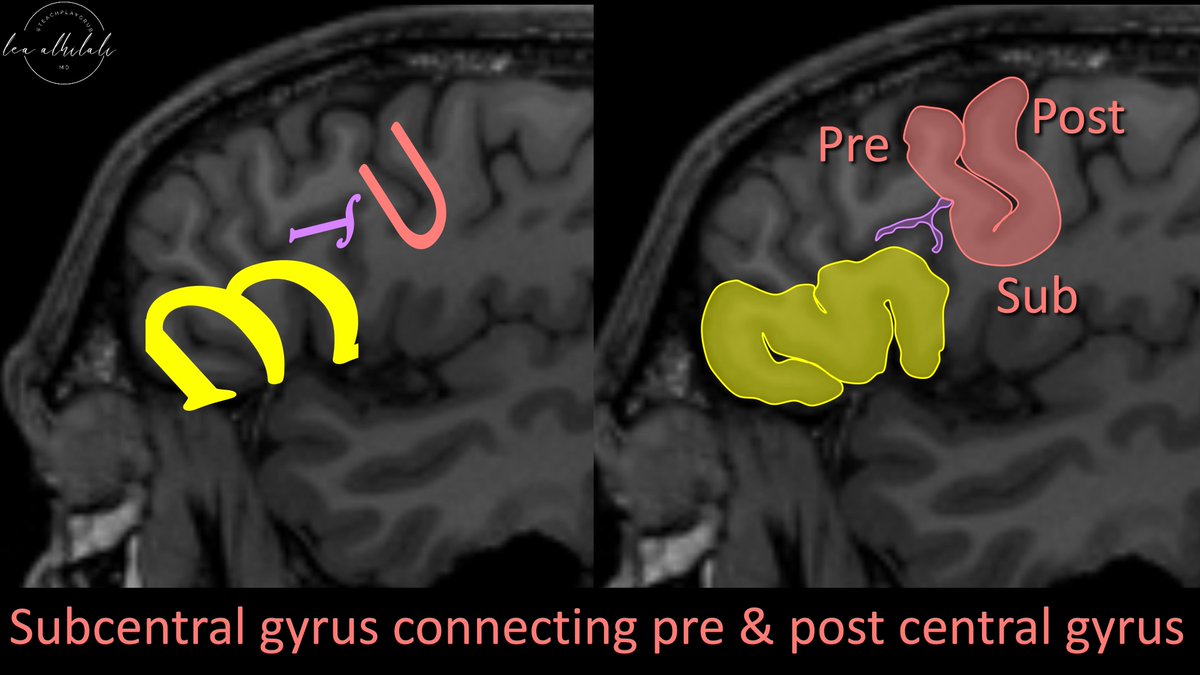 1/There’s nothing more CENTRAL to reading an MRI than finding the CENTRAL sulcus! How do YOU ...