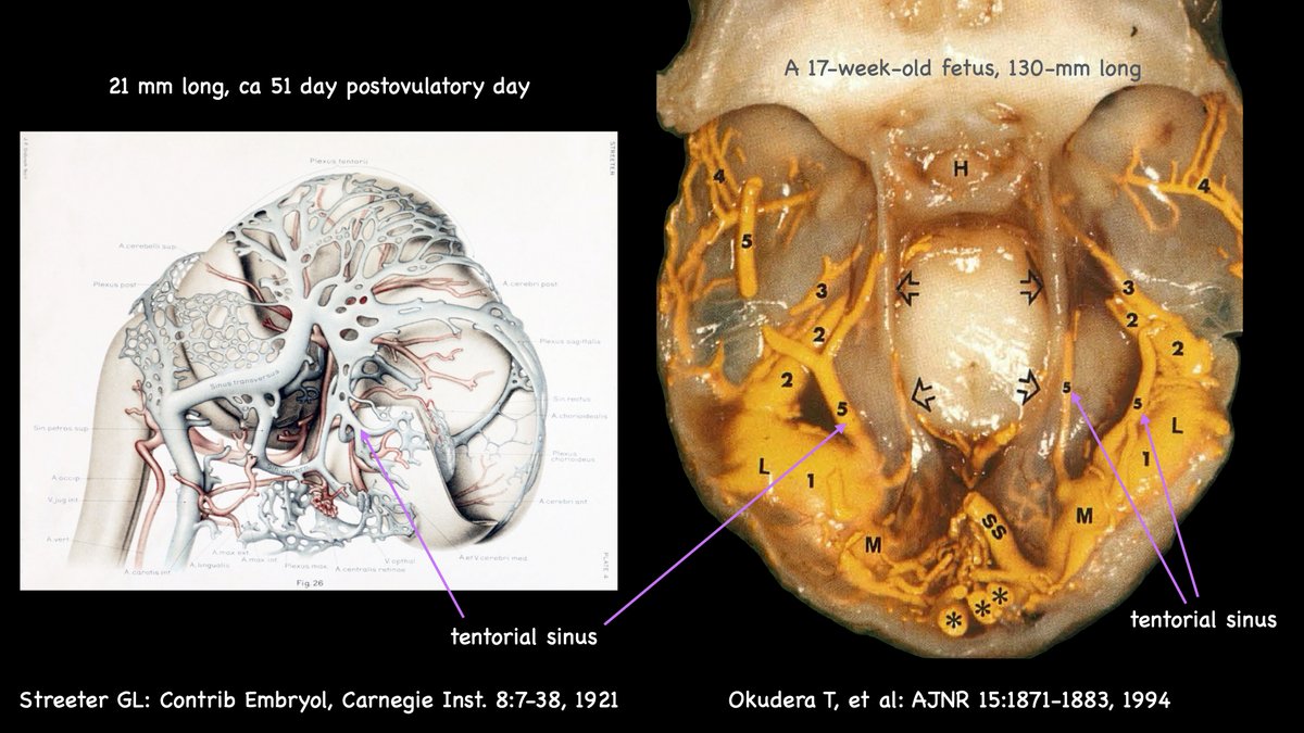 Tentorium Cerebelli Ct