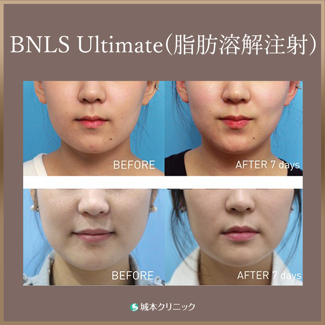 医師監修｜BNLS アルティメット（脂肪溶解注射）の口コミ・評価ランキングと注意点