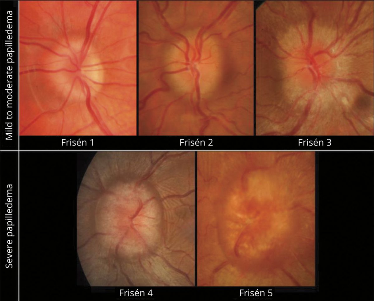37♂. Another RARE case. No PMH. Occipital headache ↑ w/ cough x 30D ...