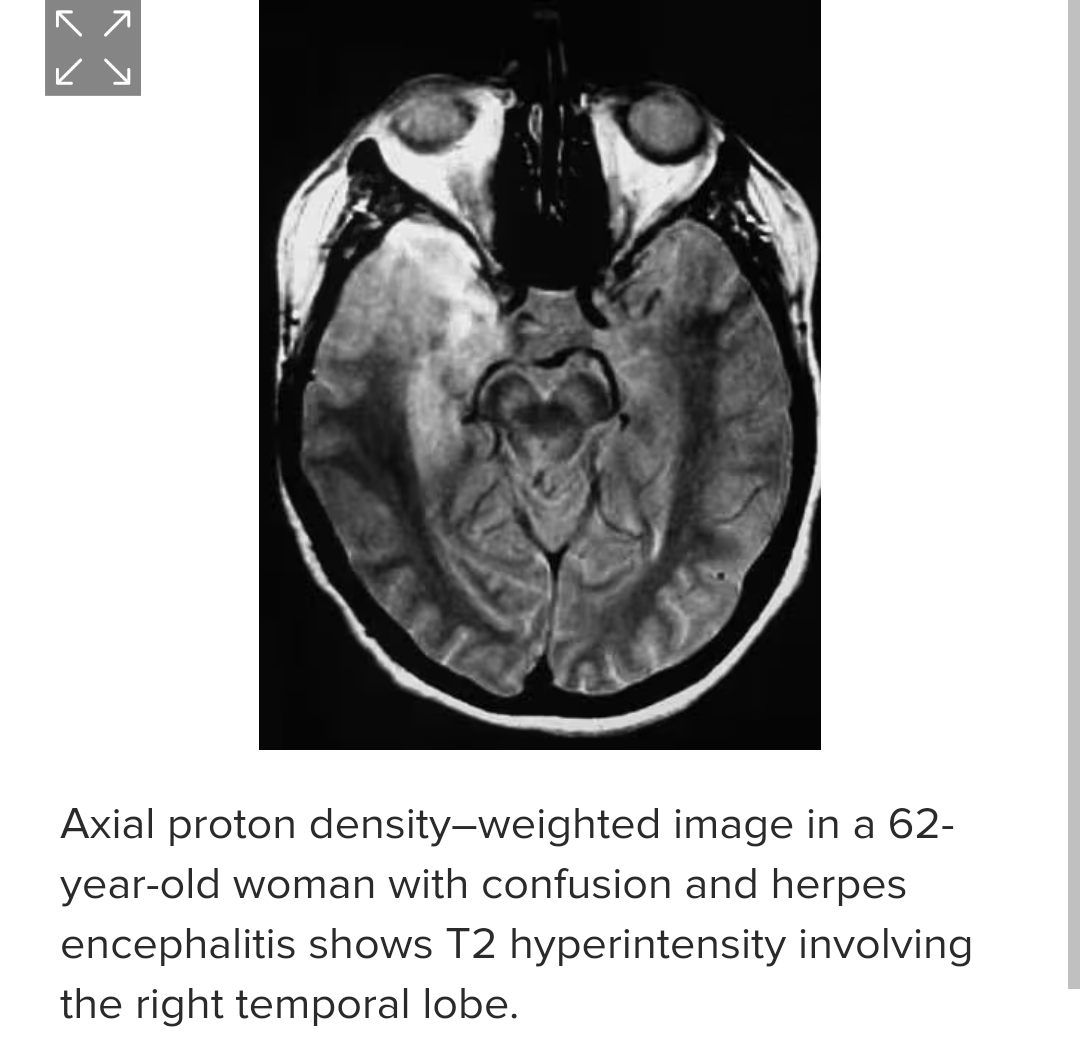 🧠 CSF HSV PCR is diagnostic of HSV encephalitis but may be negative if ...