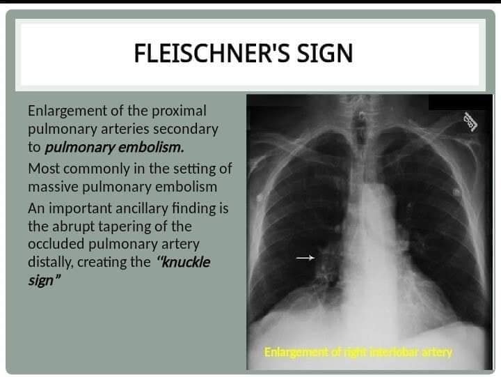 Pulmonary Embolism Chest X Ray Acute Pulmonary Embolism Mimicking