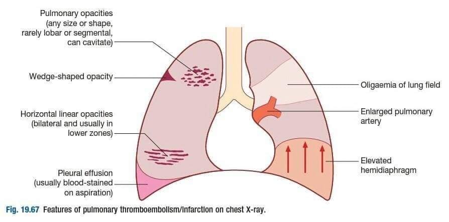 Pulmonary Embolism X Ray