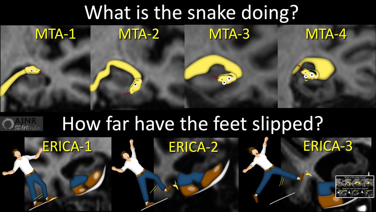 Having trouble remembering what to look for on scans for Alzheimer’s ...