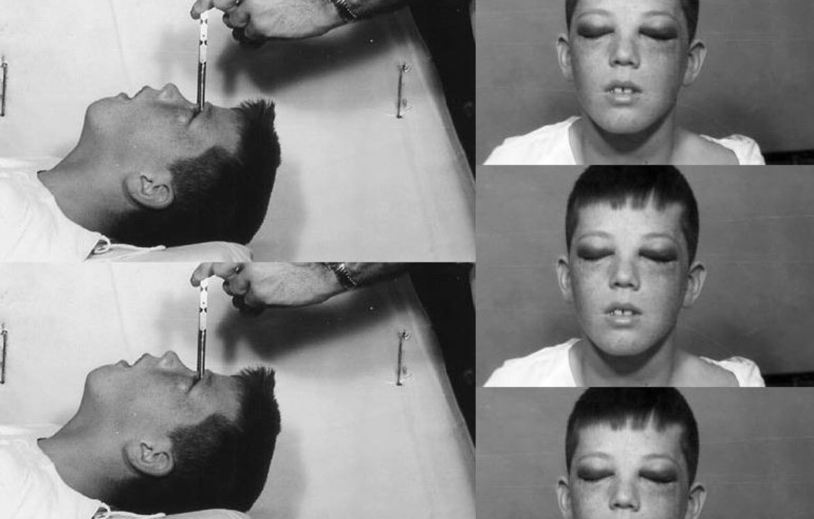 The Tragic Story of Howard Dully: A Child’s Life Altered by a Dark ...