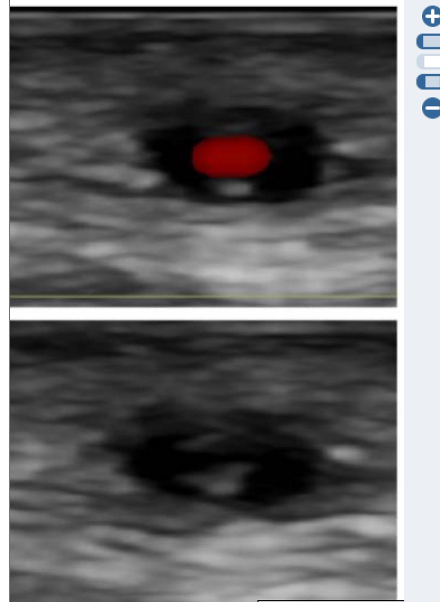 Neurology case of the day: 58 yo with medical hx of mild htn and dm ...