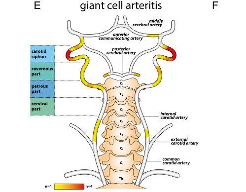 Neurology case of the day: 58 yo with medical hx of mild htn and dm ...