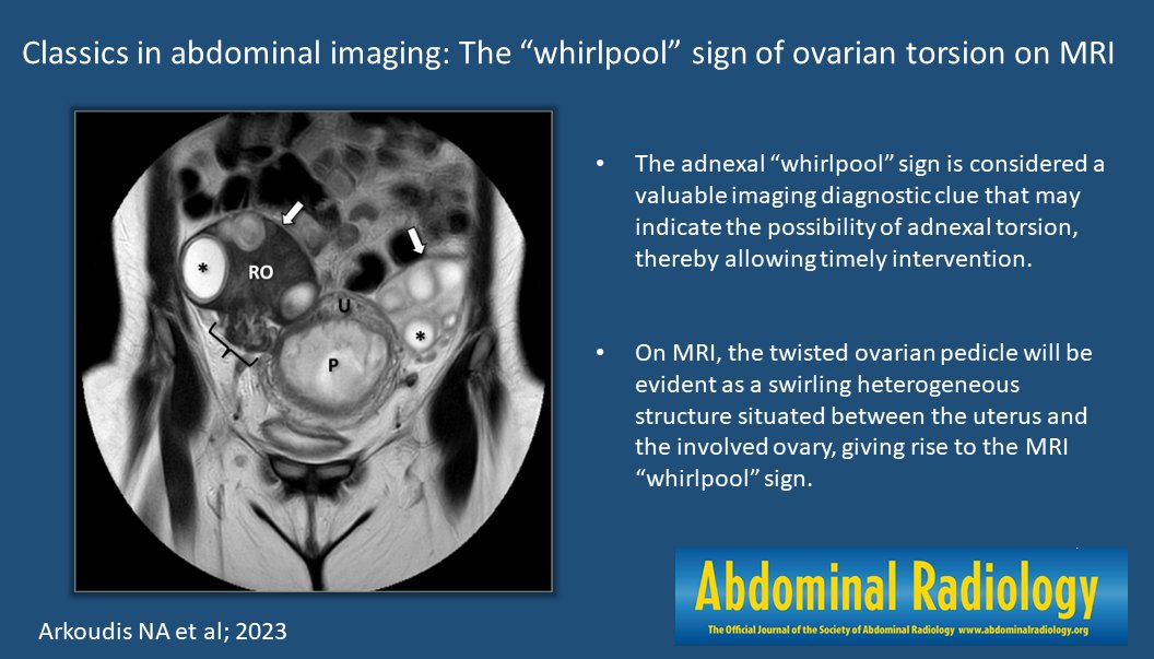 Ovarian Torsion Ultrasound Whirlpool Sign A) The Whirlpool Sign