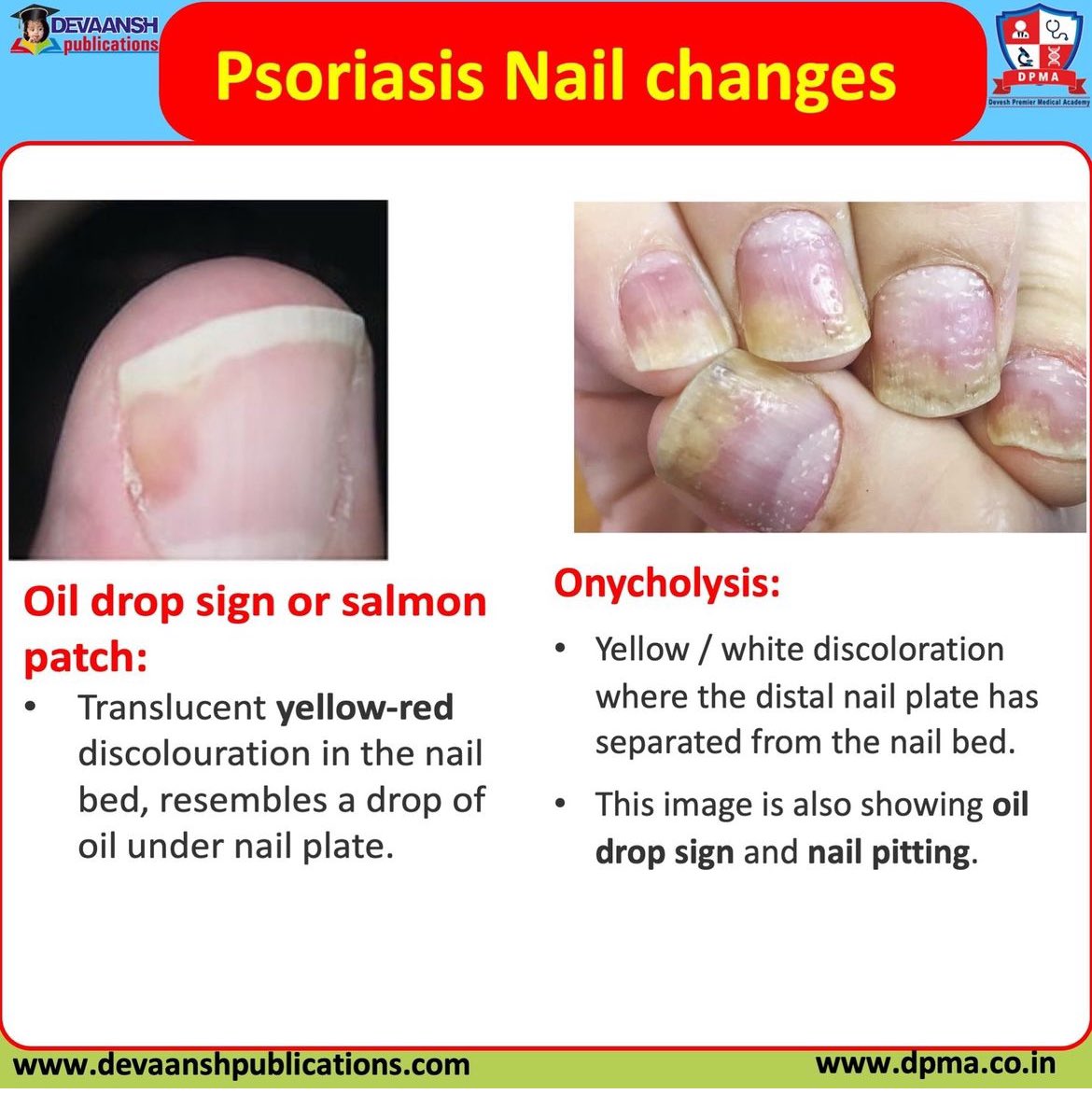 Psoriasis Nails Oil Spot X এ Dr Devesh Mishra: "🕉 Psoriasis Nail