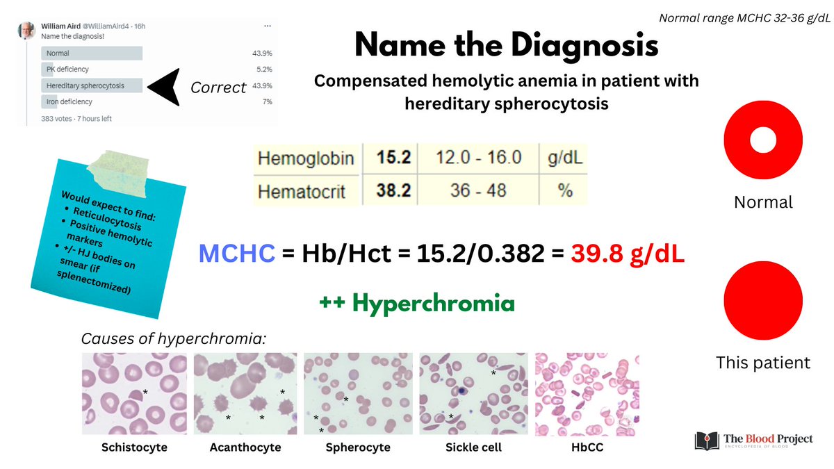 1/3 HEREDITARY SPHEROCYTOSIS I tweeted a poll asking for a diagnosis ...