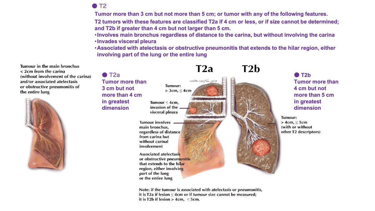 🌟 The 9th edition of TNM Classification for Lung Cancer 🫁 1, January ...