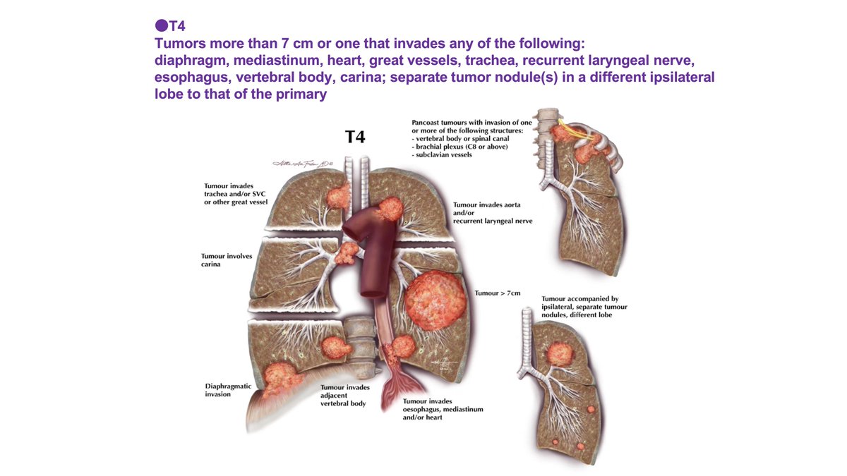 🌟 The 9th edition of TNM Classification for Lung Cancer 🫁 1, January ...