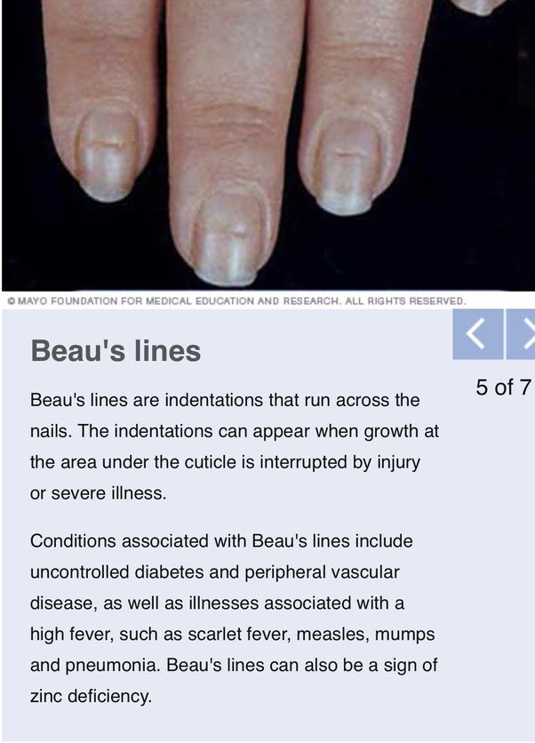 Beau Lines Causes What Do Your Nails Look Like With Kidney Disease?