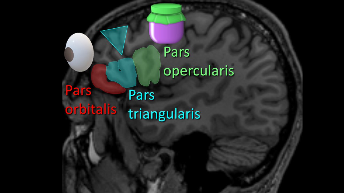 1/Do you get a Broca’s aphasia trying remember the location of Broca's ...