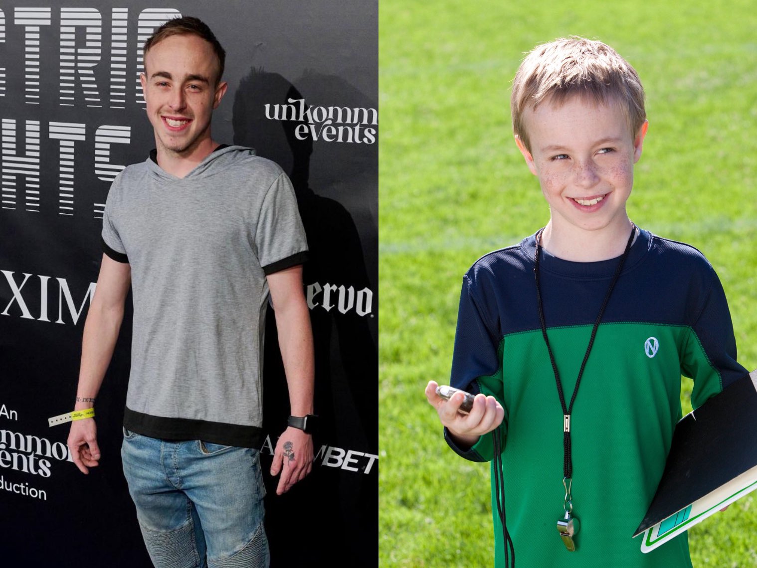 Young Jae Head (A) Schematic Description Of Shoulder Subluxation. VD