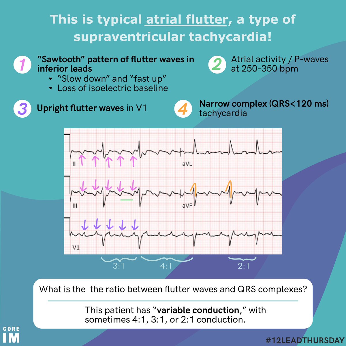 1/ 60-year-old female presents with palpitations and this EKG 🫀. Put on ...