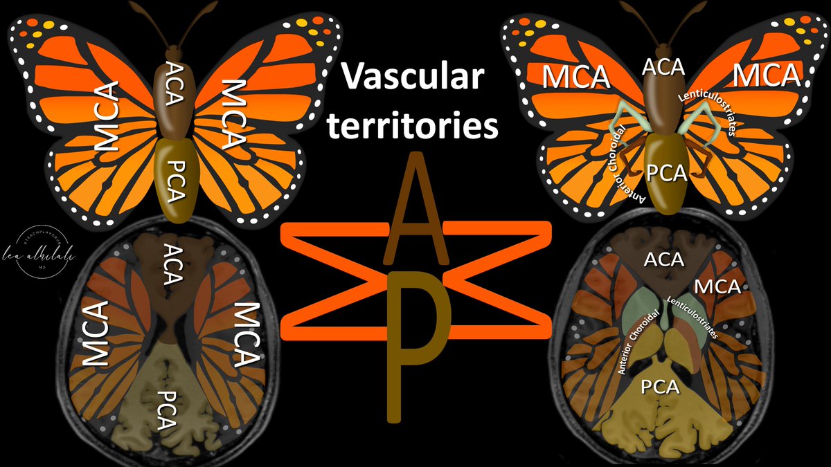 In a stroke, anyone can see the bright spot on diffusion weighted ...