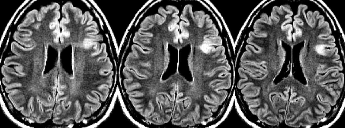 What is the most likely diagnosis in this 40 y/o M with no significant ...