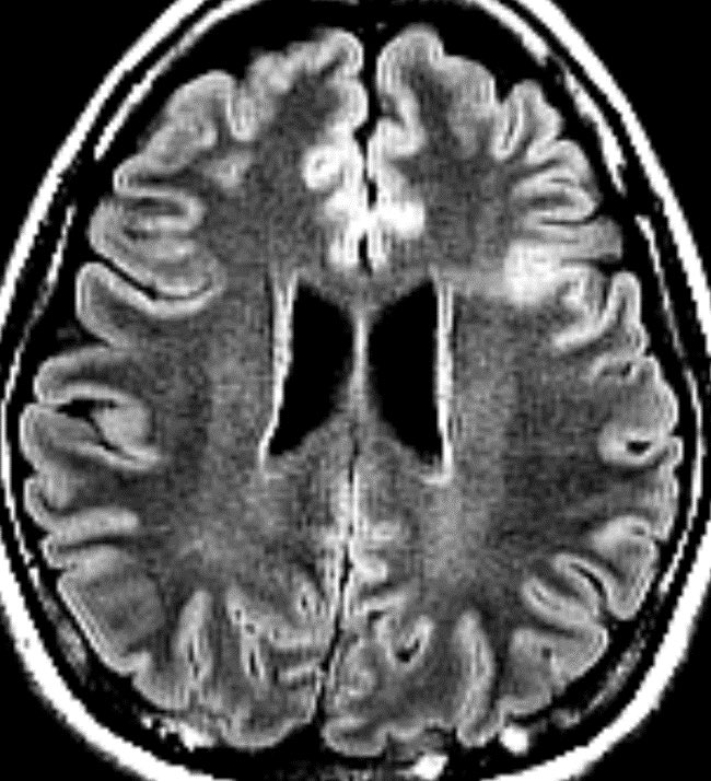 What is the most likely diagnosis in this 40 y/o M with no significant ...