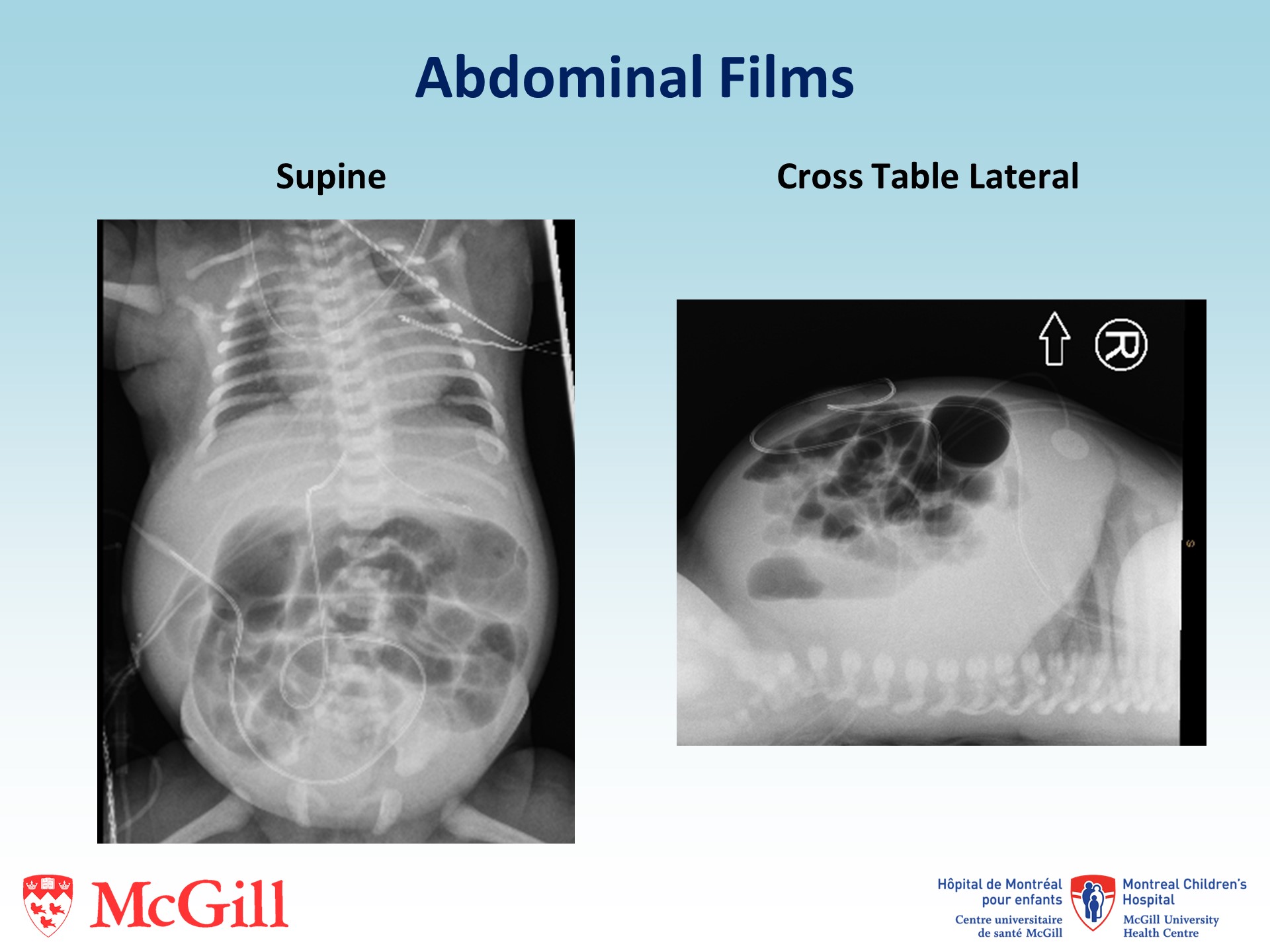 Xray Crosstable Lateral Film With The Baby In Prone How To Diagnose