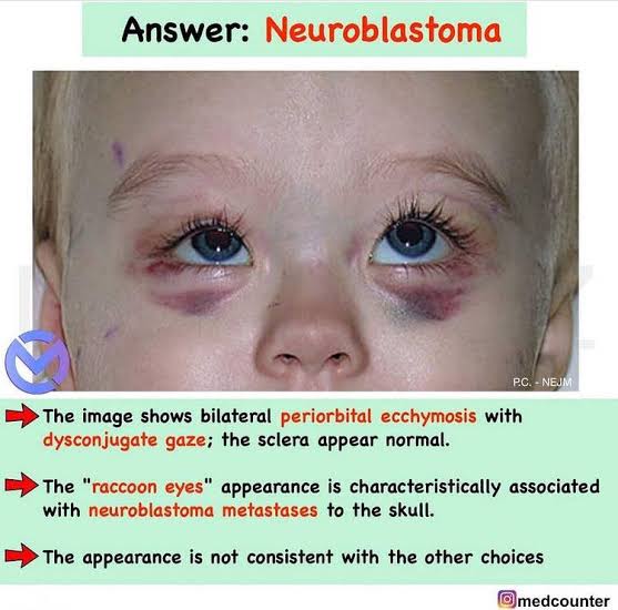 Orbital Ecchymosis Neuroblastoma