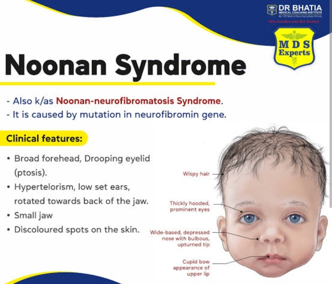 Noonan Syndrome Webbed Neck