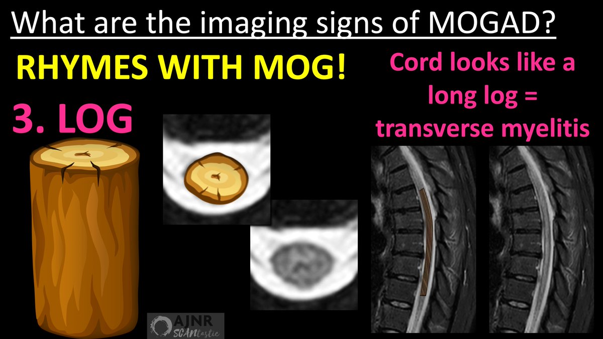 1/Are you in a FOG about MOG? MOG antibody associated disease or MOGAD ...