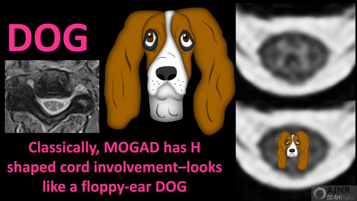 1/Are you in a FOG about MOG? MOG antibody associated disease or MOGAD ...